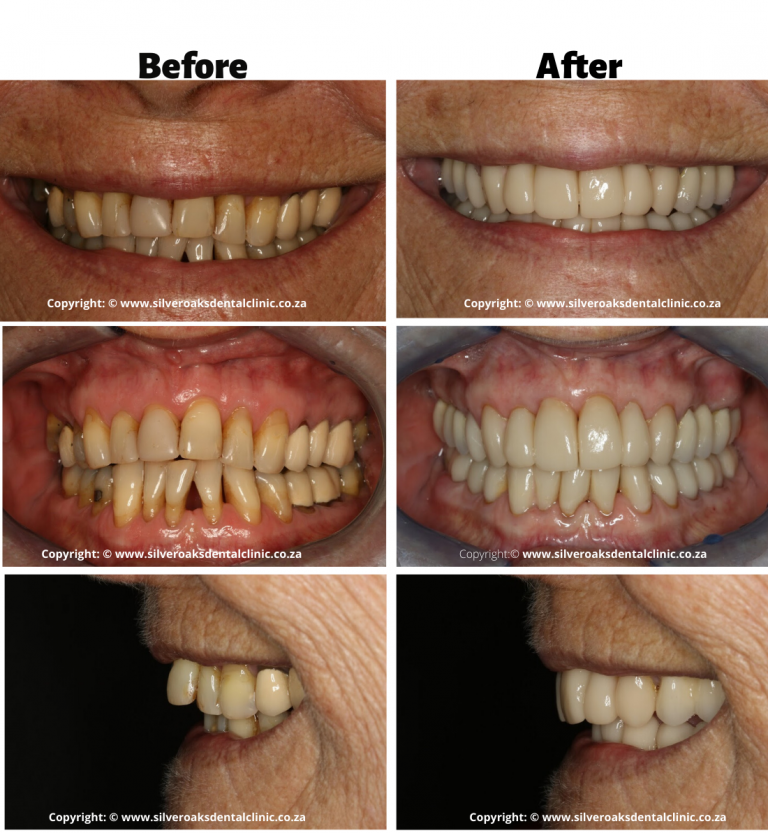 Chipped, broken, stained and misaligned teeth? | Silver Oaks Dental Clinic